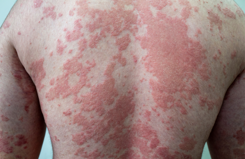 Dermatoses inflammatoires chroniques : psoriasis, hidradénite suppurée ...